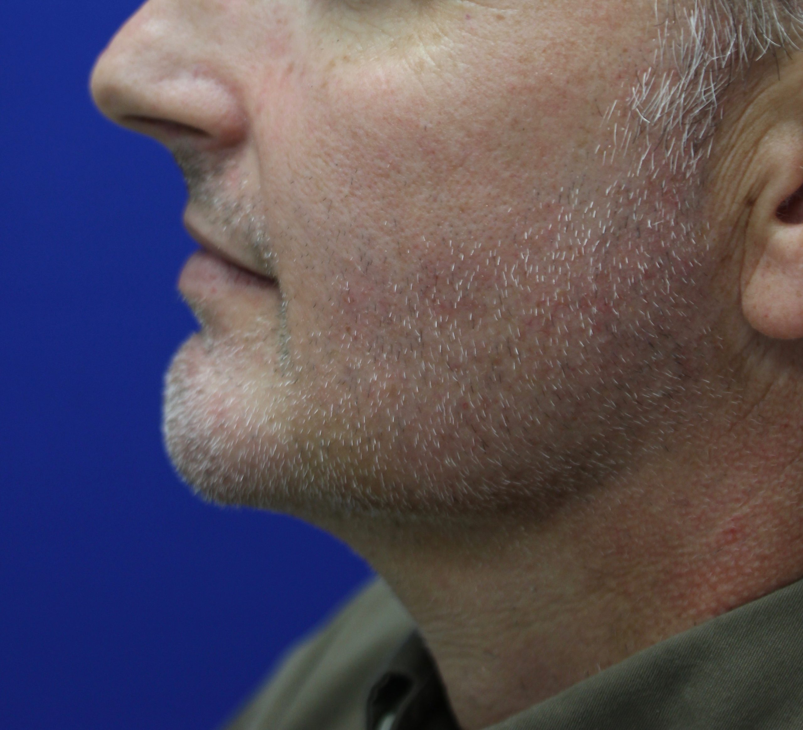 Improve Your Double Chin | Kybella Injections | Liposuction