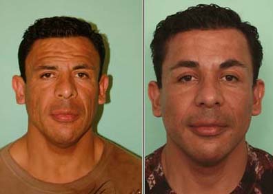 Top 10 Plastic Surgery Procedures For Men - Top Facial Plastic Surgeon ...