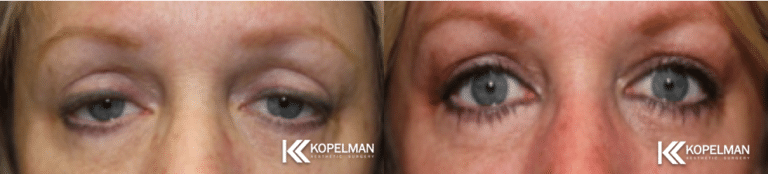 Types of Ptosis Explained: Causes, Subtypes, and Treatments