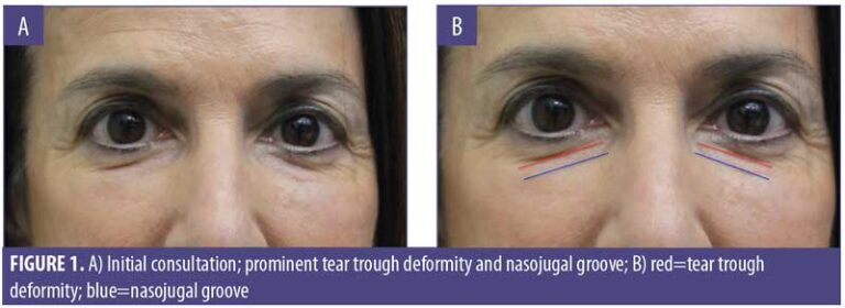 Solution to Fixing Puffy Under Eyes After Eyelid Fillers | Tear Trough ...