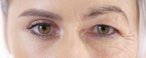 How to Remove Excess Skin on Eyelids Safely in 2025