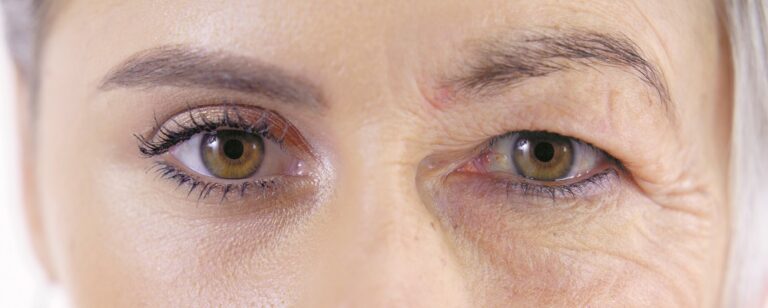 How to Remove Excess Skin on Eyelids Safely in 2025