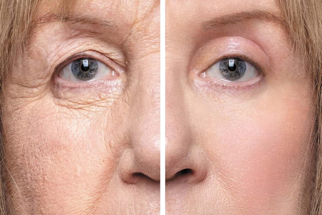 Laser Surgery for Under-Eye Bags: All you need to know 2025