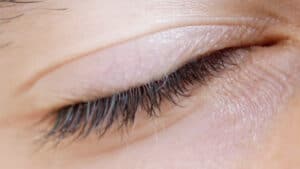 Eyelid Problems: Symptoms, Causes & Expert Treatment