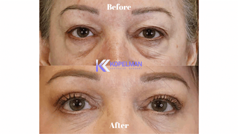 CO2 laser eyelids Before and After Photos | Dr. Kopelman