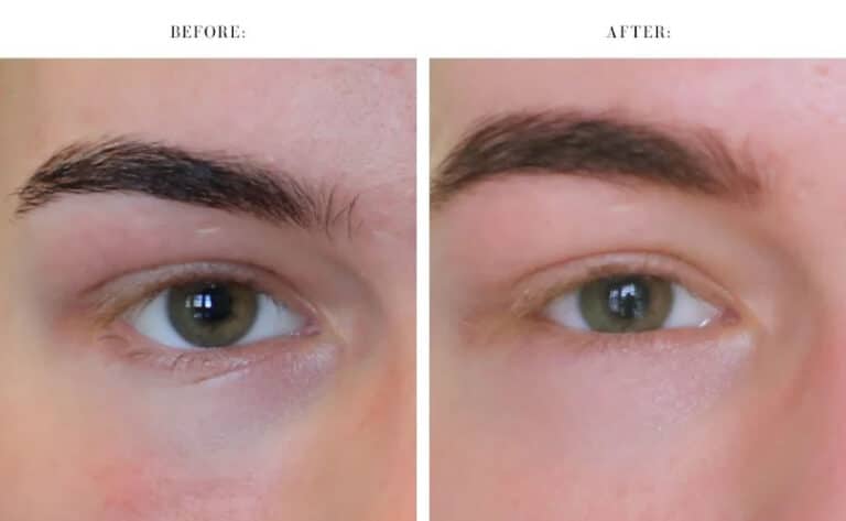 Lateral Canthoplasty Surgery: Benefits, Recovery, and Costs