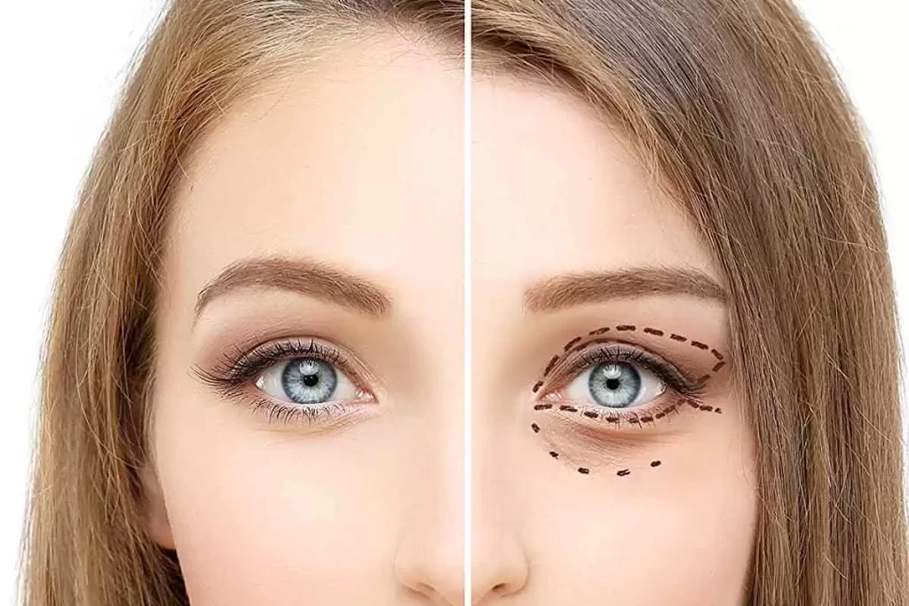 Transconjunctival Blepharoplasty: Safe Surgery Explained