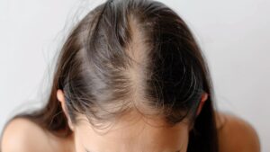 Pictures of Alopecia Hair Loss – Causes, Types, Treatments