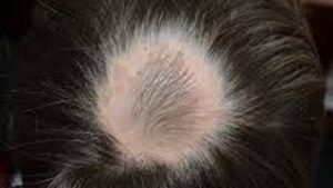 Pictures of Alopecia Hair Loss – Causes, Types, Treatments