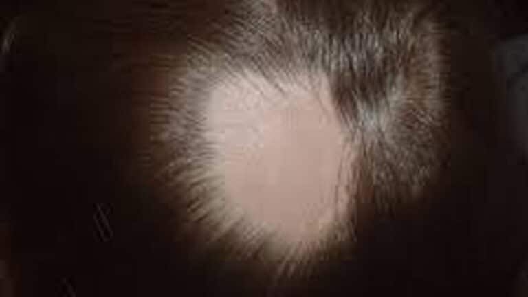 Pictures of Alopecia Hair Loss – Causes, Types, Treatments