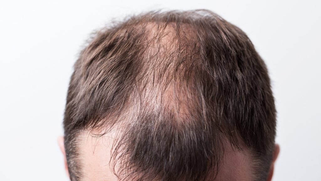 Pictures of Alopecia Hair Loss – Causes, Types, Treatments