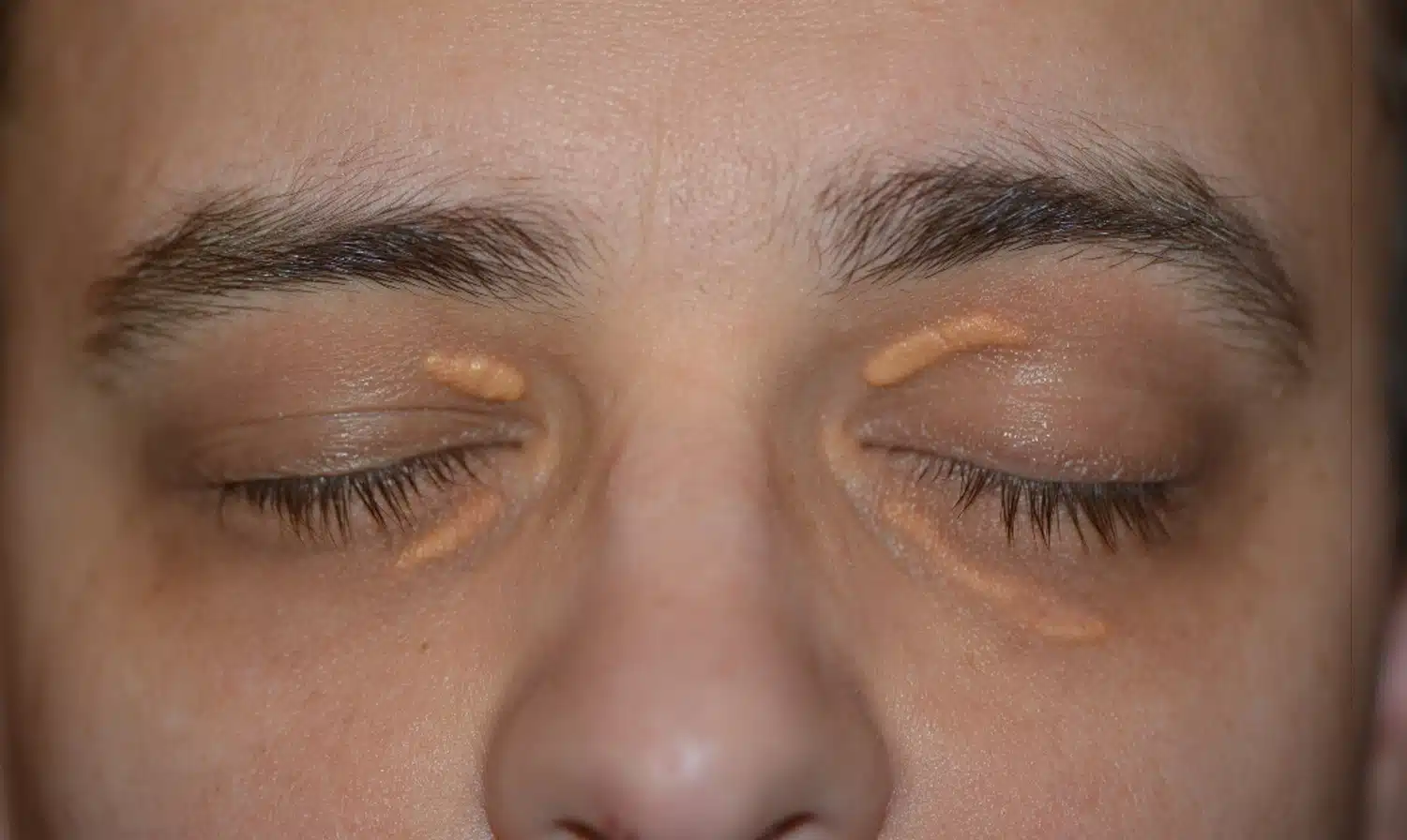 Eyelid Bumps Guide: How to Identify and Treat Them